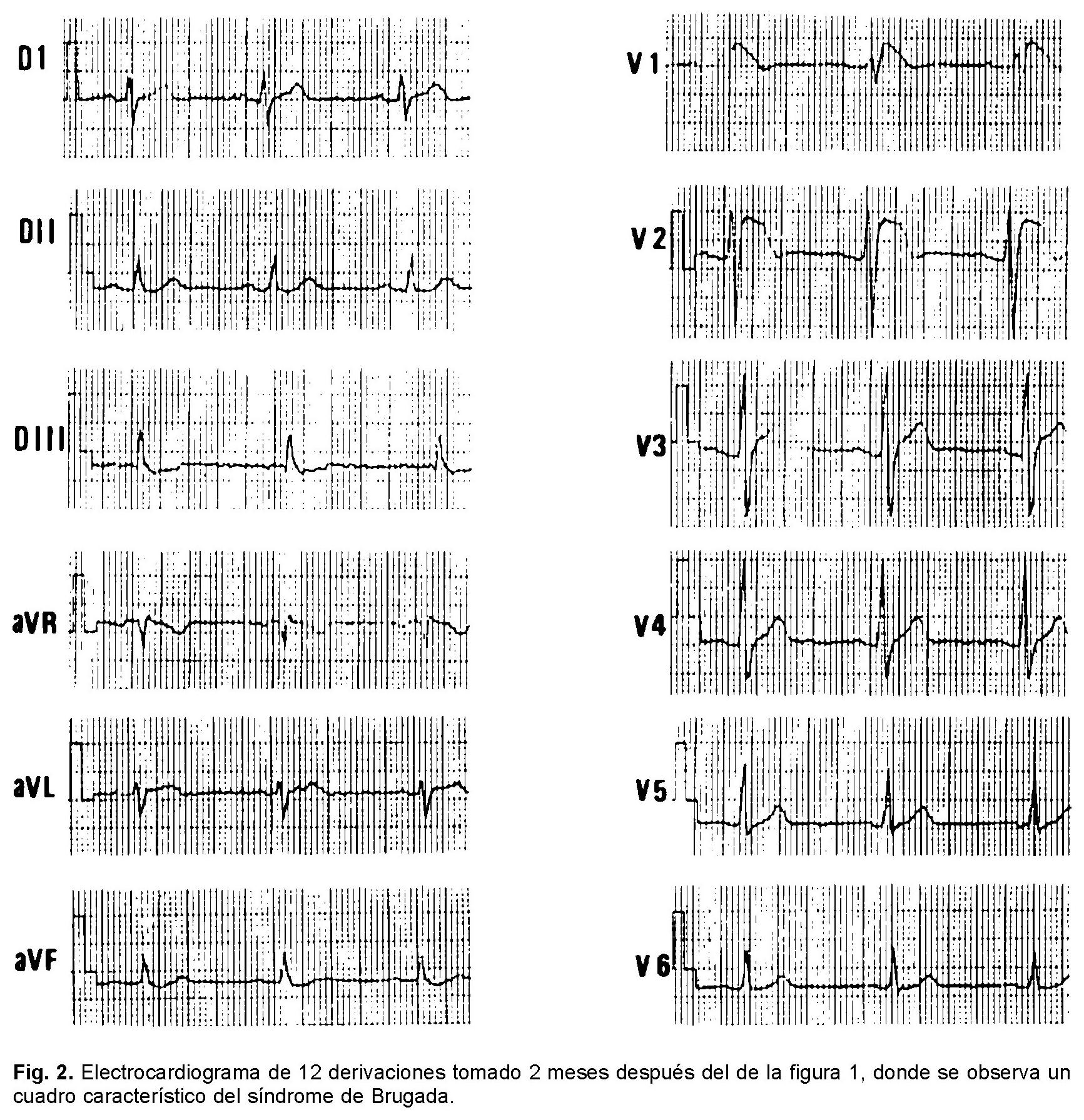 Alteraciones electrocardiográficas durante el esfuerzo en un paciente ...