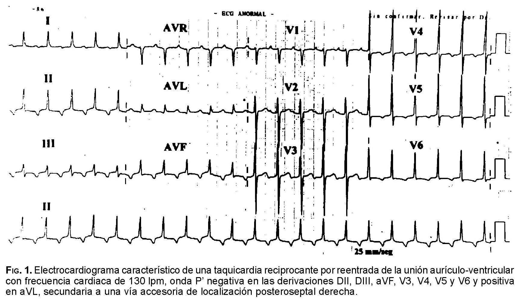 Taquicardia reciprocante permanente de la unión AV (tipo Coumel)
