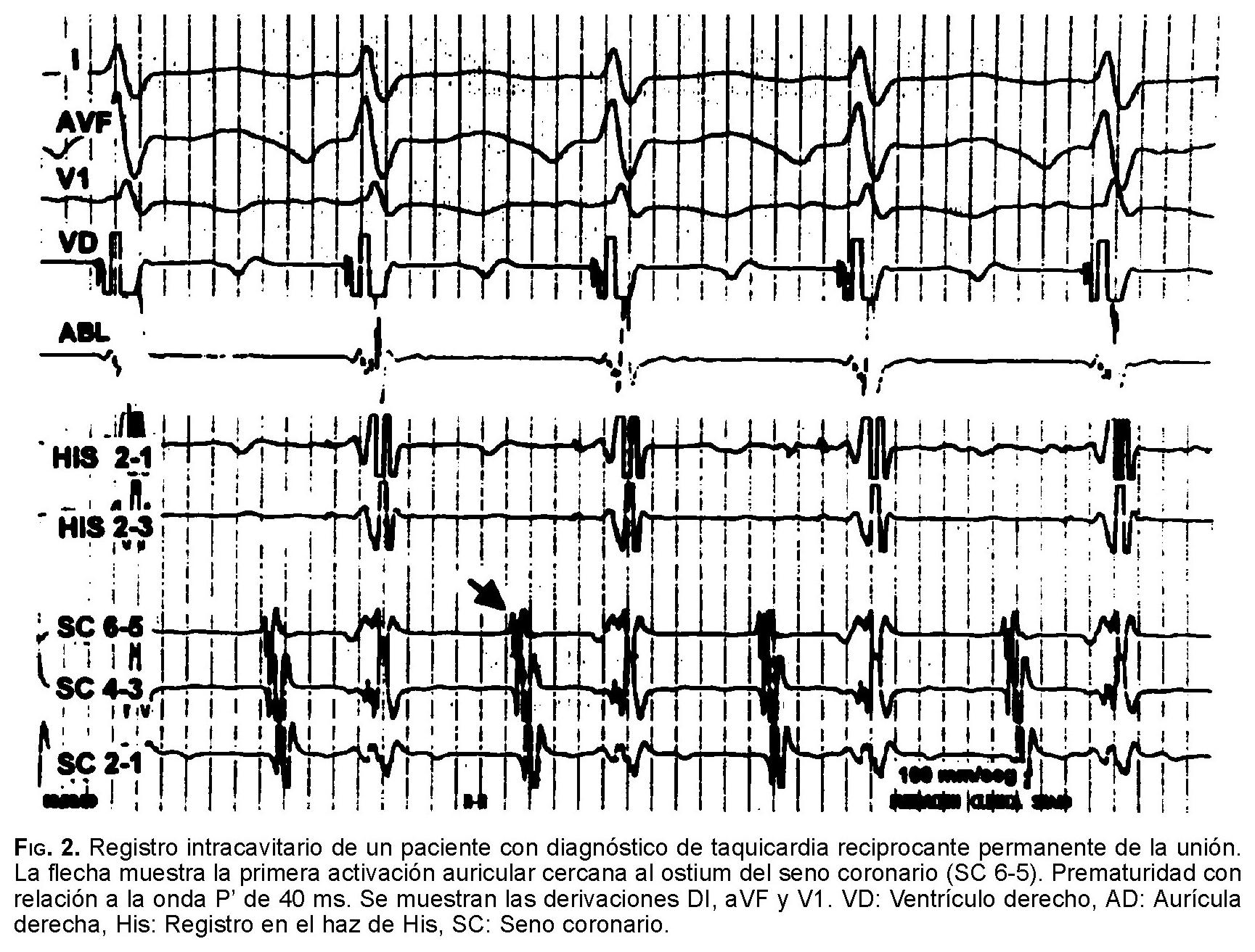 Taquicardia reciprocante permanente de la unión AV (tipo Coumel)
