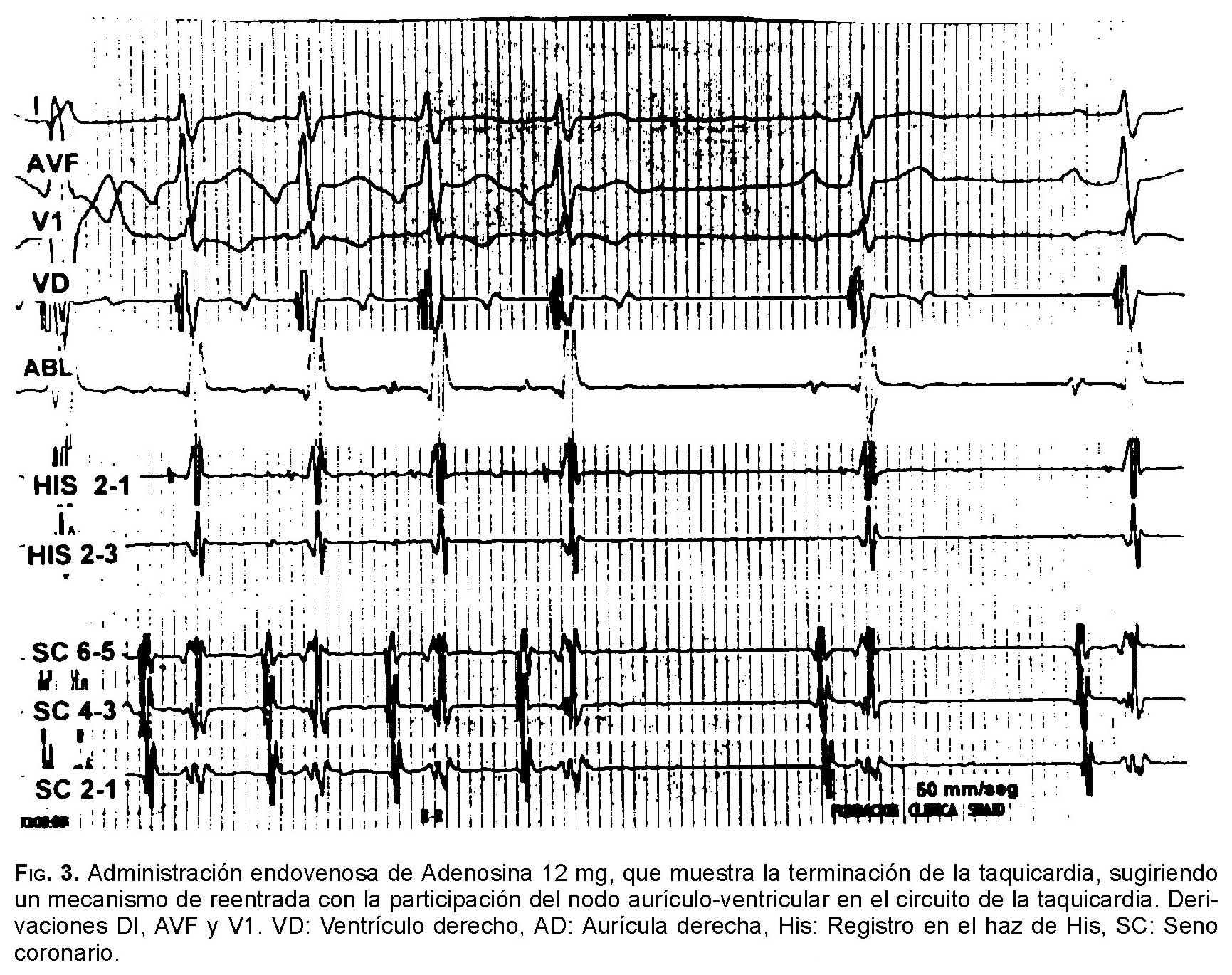 Taquicardia reciprocante permanente de la unión AV (tipo Coumel)