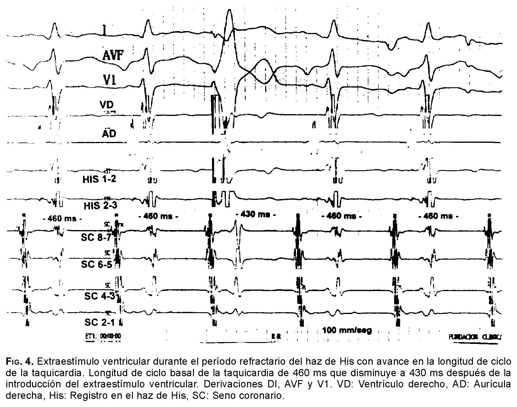 Taquicardia reciprocante permanente de la unión AV (tipo Coumel)