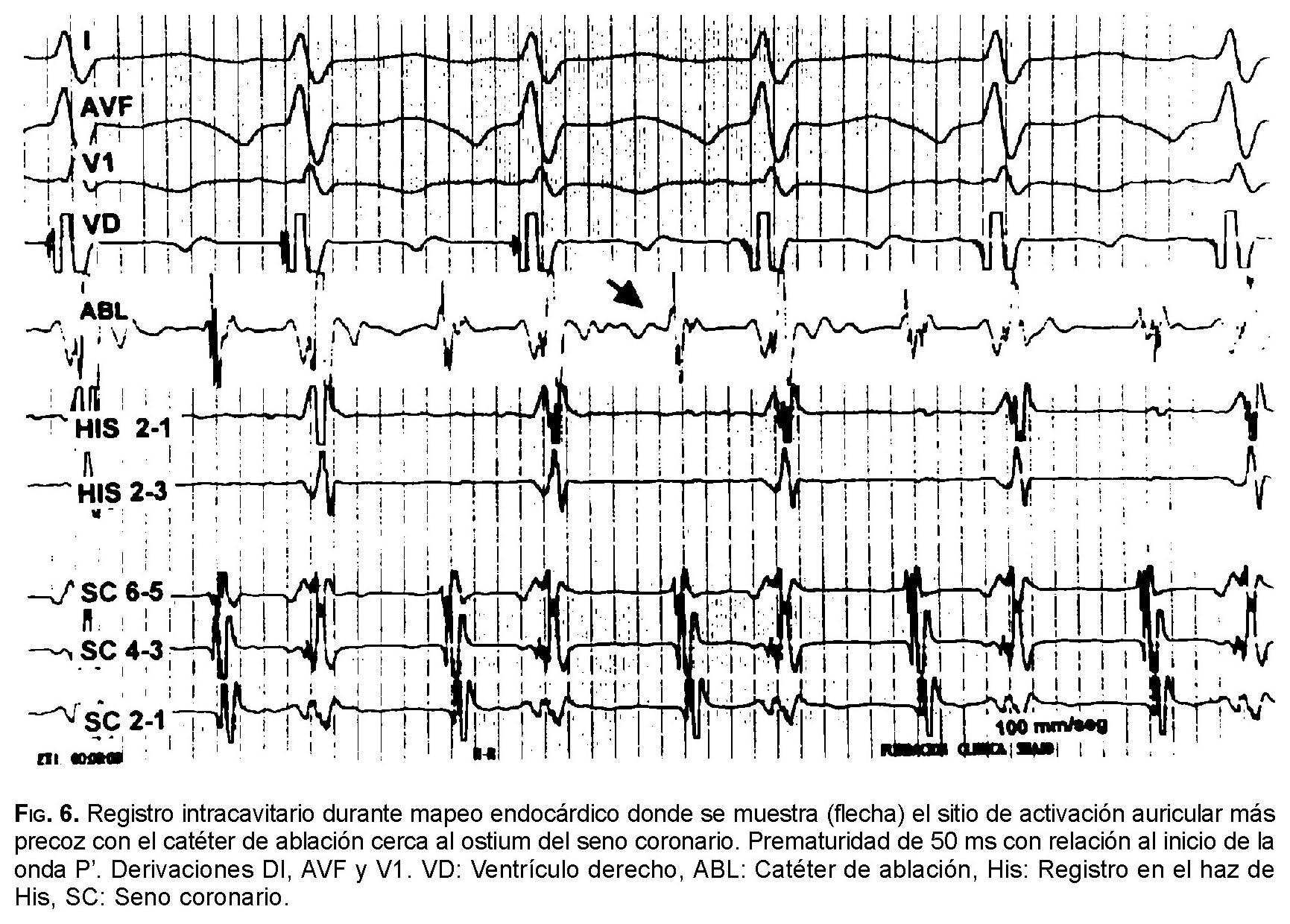 Taquicardia reciprocante permanente de la unión AV (tipo Coumel)