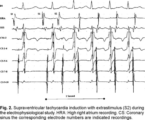 Bystander coronary sinus diverticulum and left anterolateral accessory ...