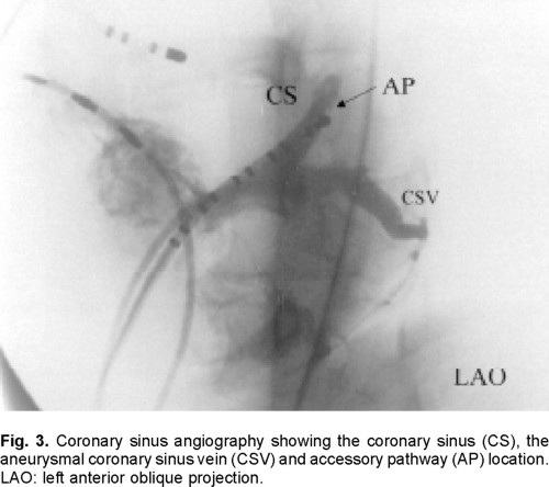 Bystander coronary sinus diverticulum and left anterolateral accessory ...