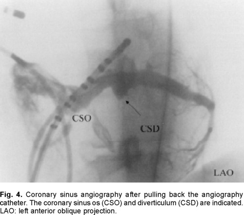 Bystander coronary sinus diverticulum and left anterolateral accessory ...