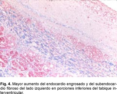 Fibrosis miocárdica septal: Un cotejo electro-histológico