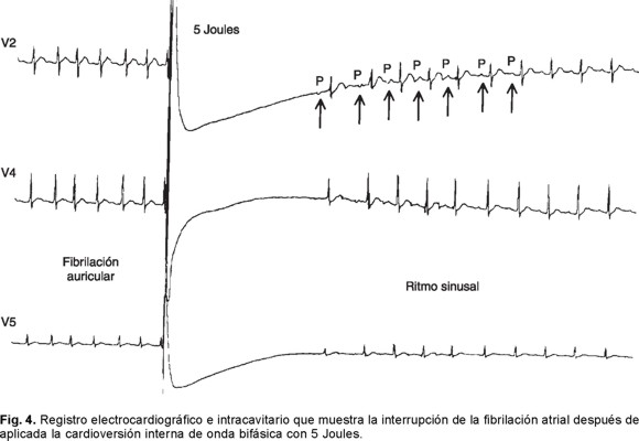 Cardioversión interna de la fibrilación auricular crónica