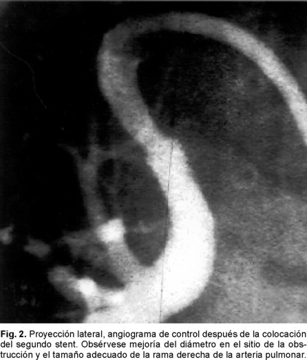 Stent y redilatación con globo del conducto arterioso en ventrículo ...