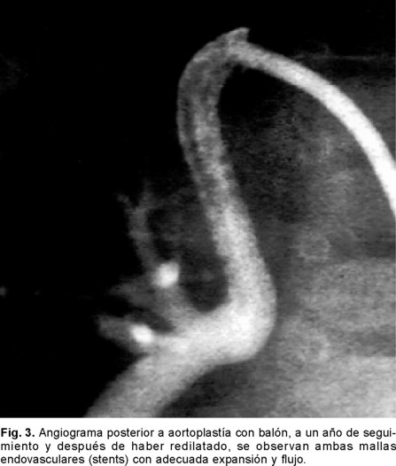 Stent y redilatación con globo del conducto arterioso en ventrículo ...
