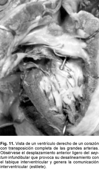 Obstrucción en las vías de salida en la transposición completa de las ...