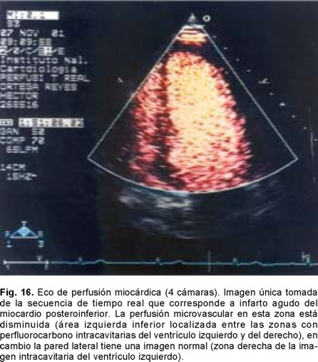La meta de la reperfusión en los síndromes isquémicos coronarios agudos ...