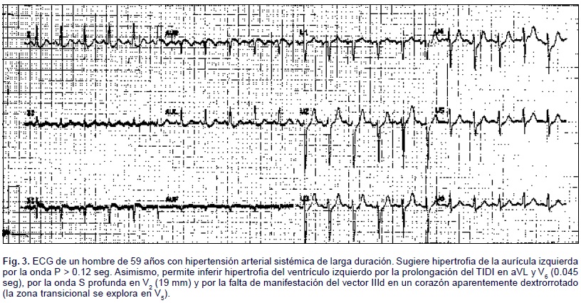 Aspectos eléctricos de la hipertrofia del corazón izquierdo