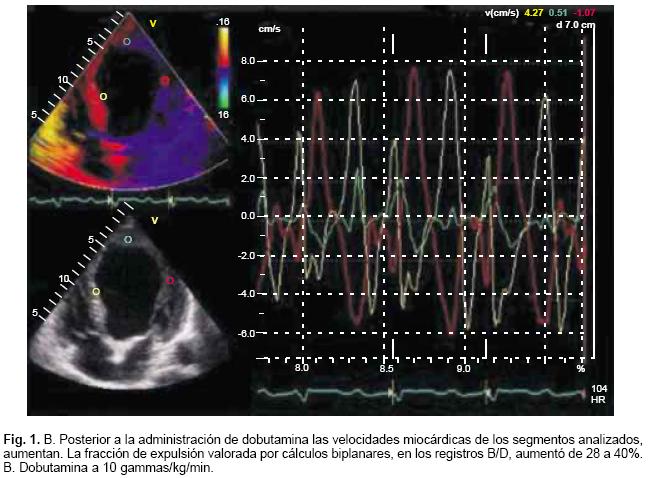 Insuficiencia aórtica grave, reserva contráctil y Doppler tisular