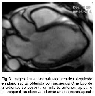 Abordaje diagnóstico de las miocardiopatías mediante resonancia magnética