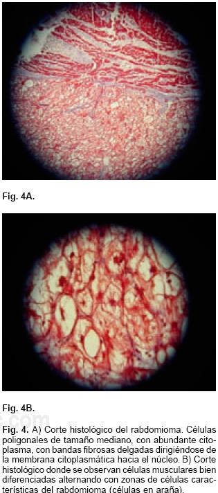 Rabdomioma cardiaco tratado quirúrgicamente con éxito y revisión de la ...
