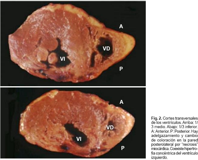 Infartos posterolaterales biventriculares: Un cotejo electro-anatómico
