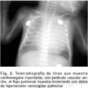 Aspectos clínicos de criss-cross: A propósito de un caso