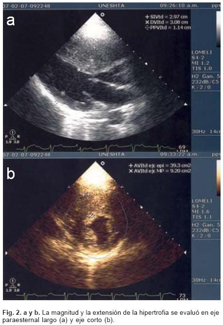 Obstrucción en la vía de salida del ventrículo derecho en la ...