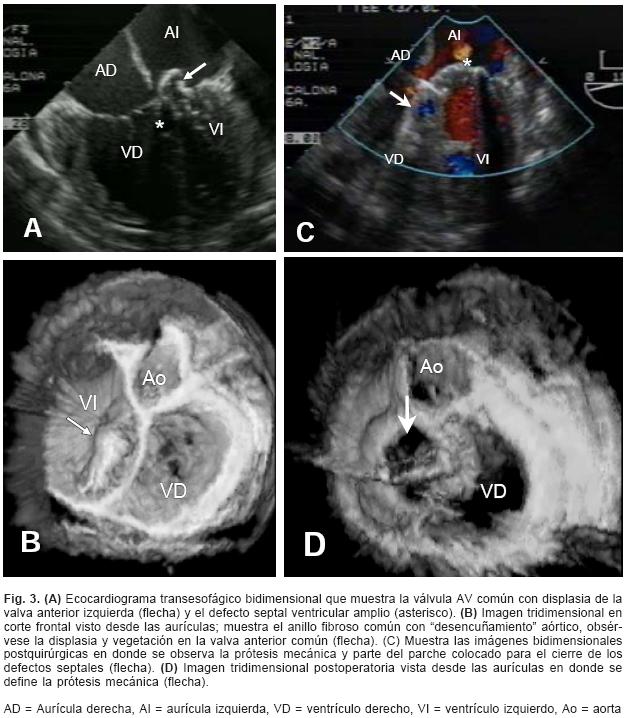 Espectro anatómico entre el defecto de la tabicación atrioventricular ...