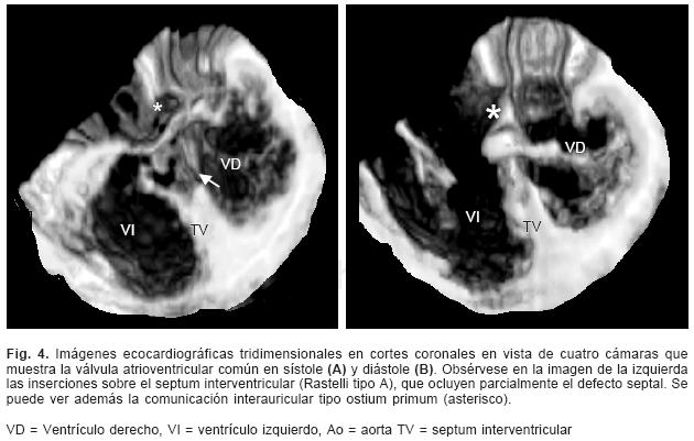 Espectro anatómico entre el defecto de la tabicación atrioventricular ...