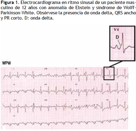 Diagnóstico de las taquiarritmias en el paciente pediátrico