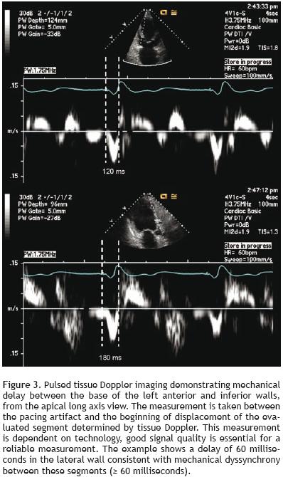Cardiac resynchronization therapy: evaluation of ventricular ...