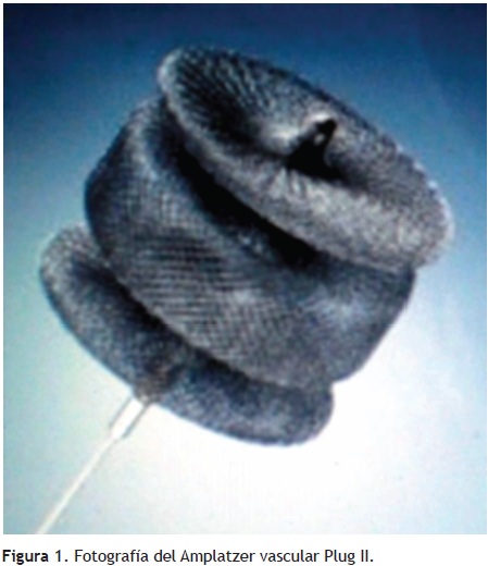 Cierre percutáneo del conducto arterioso permeable utilizando el ...