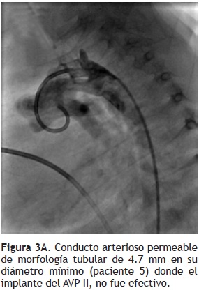 Cierre percutáneo del conducto arterioso permeable utilizando el ...