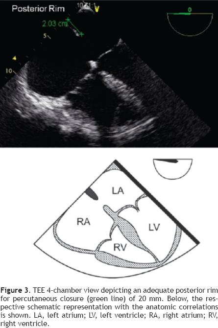 Multiplanar transesophageal echocardiography for the evaluation and ...