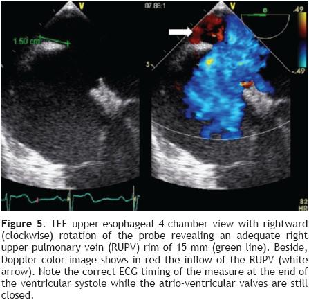 Multiplanar transesophageal echocardiography for the evaluation and ...
