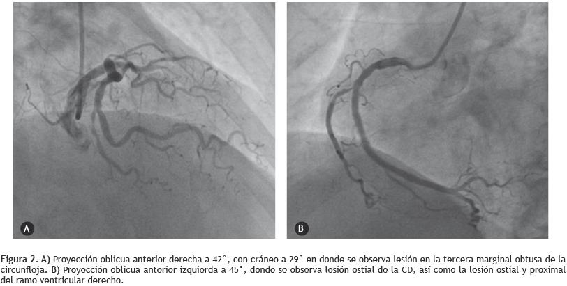 Importancia de la cuantificación del flujo coronario mediante PET, en ...