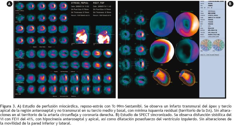 Importancia de la cuantificación del flujo coronario mediante PET, en ...