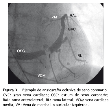 Estado actual de la terapia de resincronización cardiaca