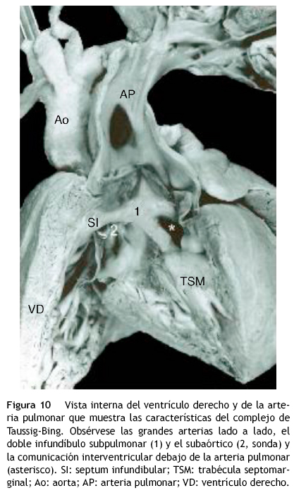 Doble salida de ventrículo derecho: Enfoque embriológico