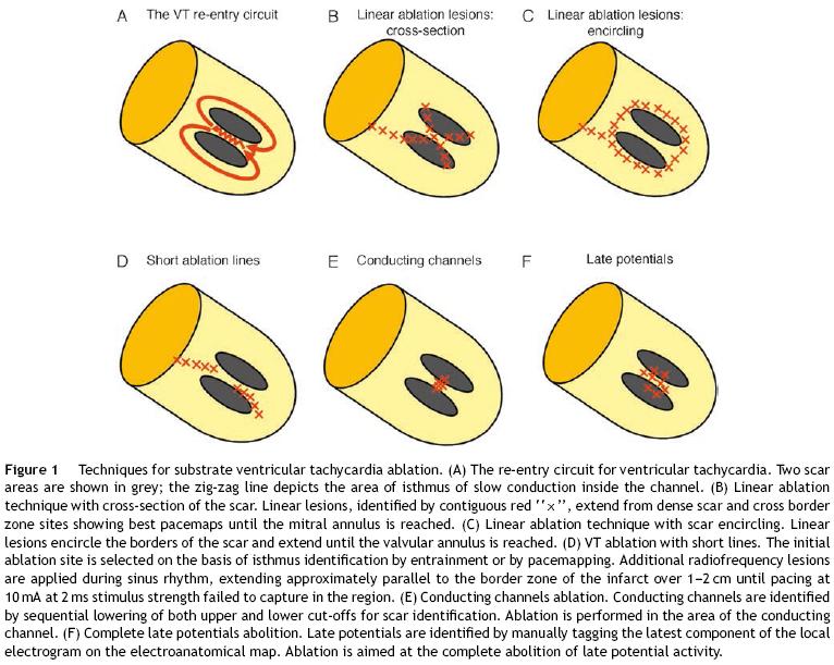 Substrate mapping strategies for successful ablation of ventricular ...