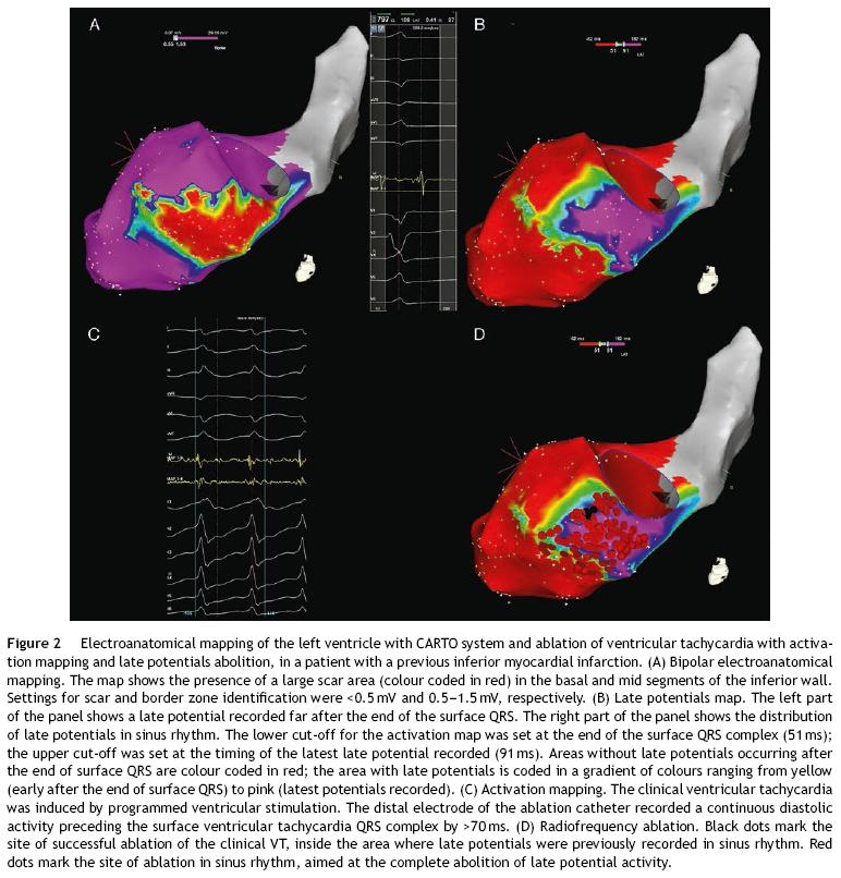 Substrate mapping strategies for successful ablation of ventricular ...