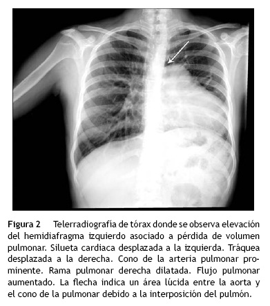 Defecto de la tabicación atrioventricular con 2 válvulas asociado a ...
