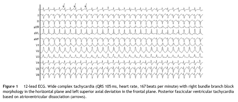 Cardiomyopathy induced by incessant fascicular ventricular tachycardia