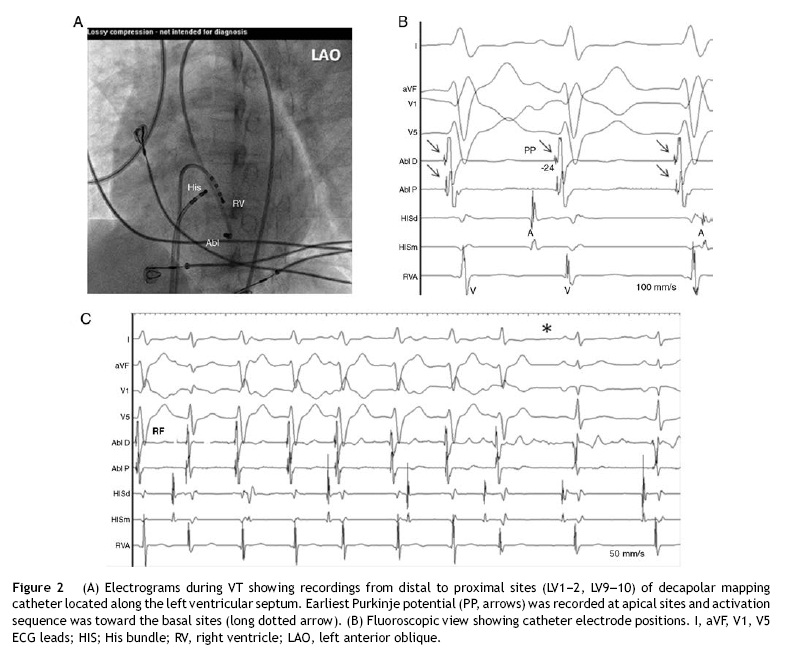 Cardiomyopathy induced by incessant fascicular ventricular tachycardia