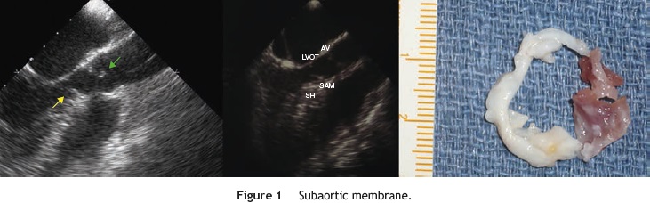 Aortic stenosis in the background of a subaortic membrane and tunnel ...