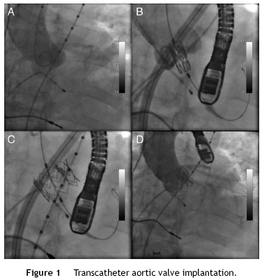 Start-up of the program of transcatheter aortic valve implantation ...