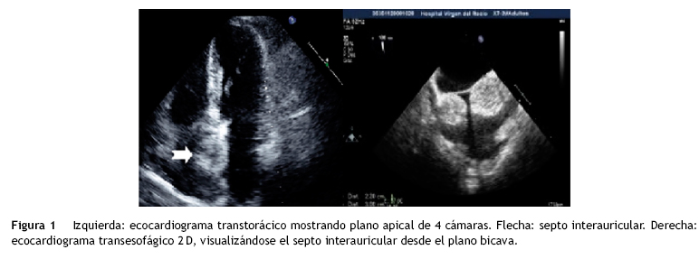 Hipertrofia lipomatosa masiva del septo interauricular: diagnóstico por ...