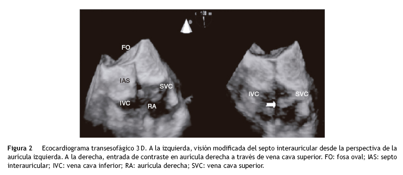 Hipertrofia lipomatosa masiva del septo interauricular: diagnóstico por ...