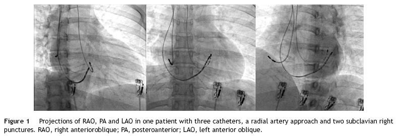 Electrophysiological interventions without using femoral approach