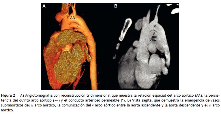 Persistencia del quinto arco aórtico asociado a persistencia del ...