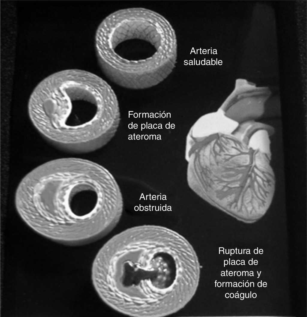 Colesterol y aterosclerosis. Consideraciones históricas y tratamiento