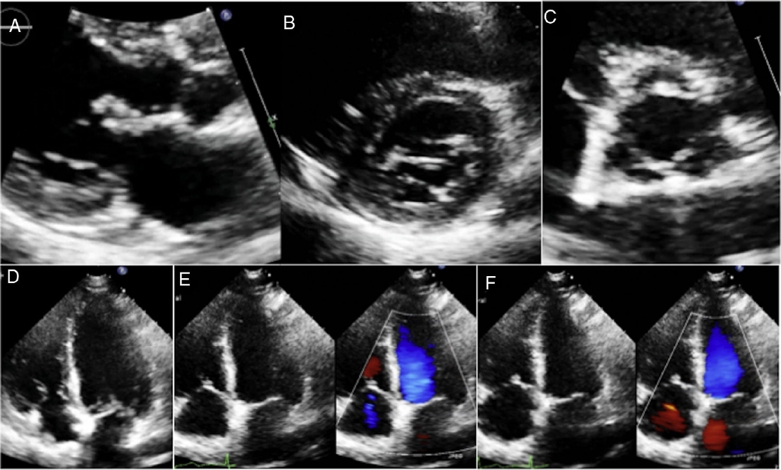 Rheumatoid arthritis: A case of multivalvular heart disease