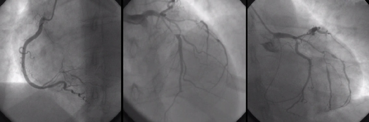 Multivessel spontaneous coronary artery dissection in a puerperal young ...