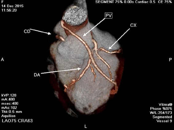 Multivessel spontaneous coronary artery dissection in a puerperal young ...