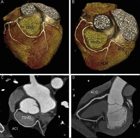 ¿Dónde está el tronco coronario izquierdo?